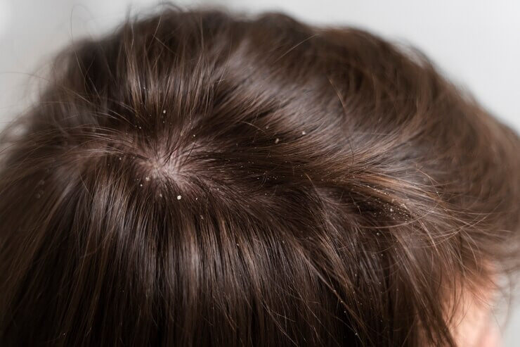 The Ultimate Guide to Understanding Dandruff and Its Causes Best ...
